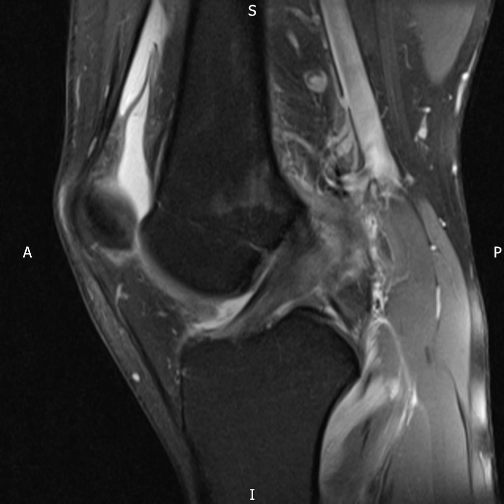 Anterior Cruciate Ligament | Buckinghamshire knee surgery