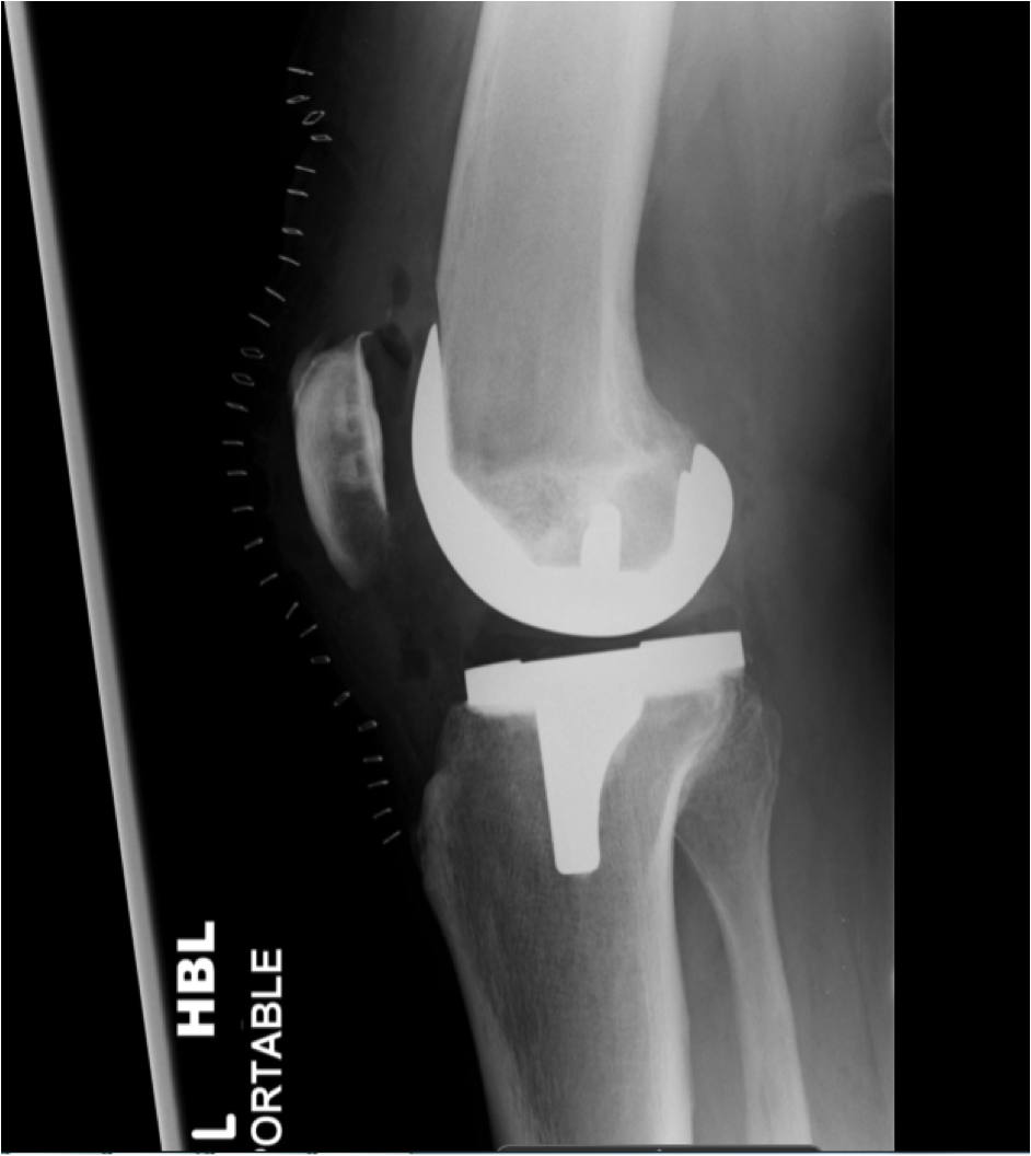 Total Knee Replacement | Buckinghamshire knee surgery