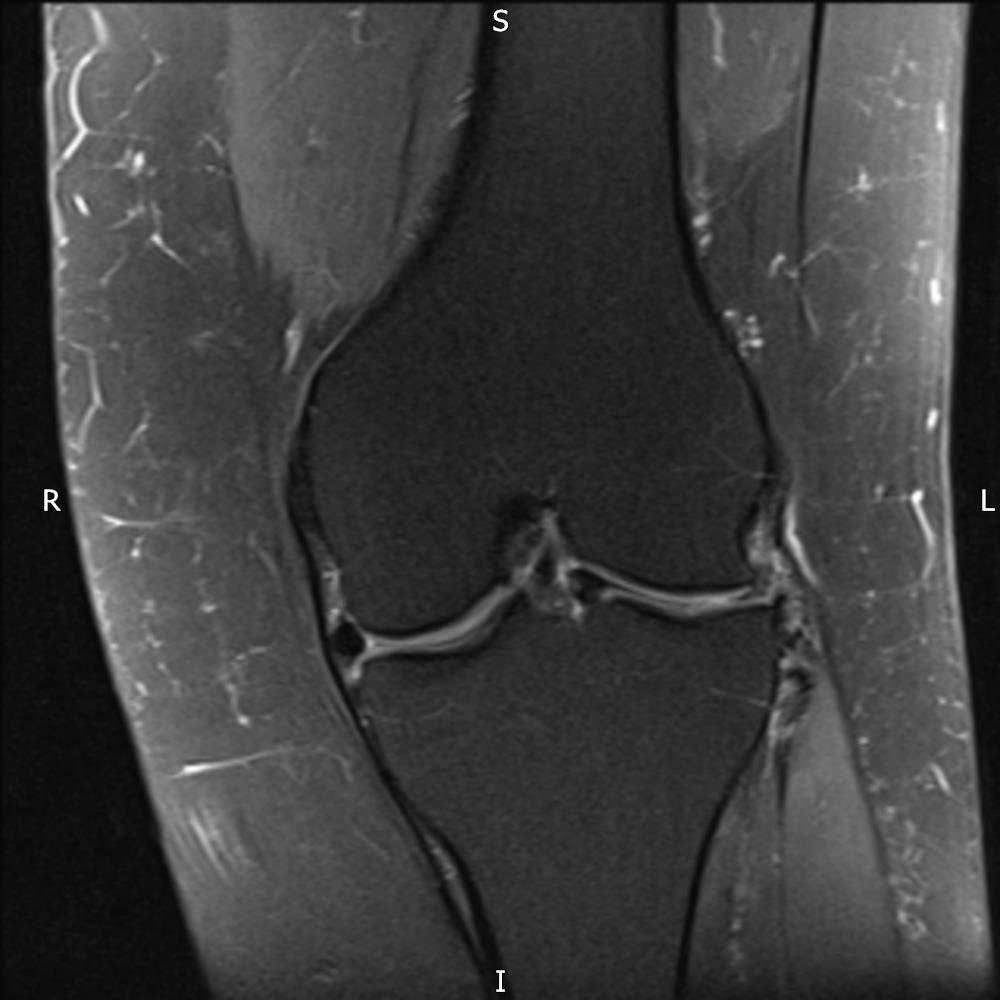 Keyhole Knee Surgery | Buckinghamshire knee surgery